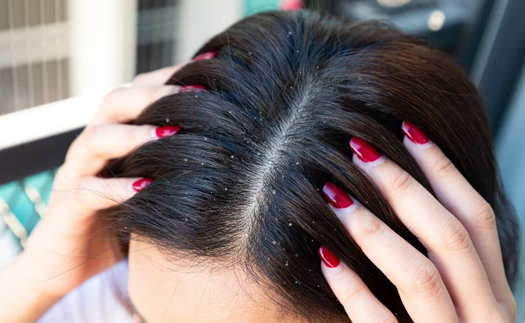 Dandruff Treatment at Home - beautibite